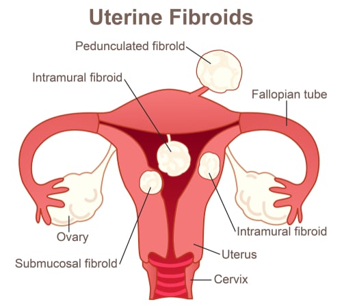 What Is A Submucosal Uterine Fibroid Carnegie Womens Health What Is A Submucosal Uterine Fibroid Carnegie Womens Health